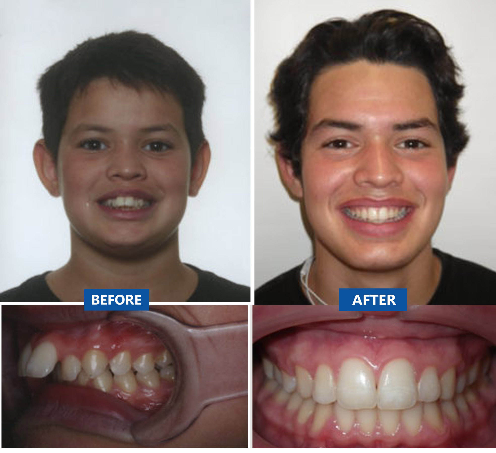 Braces Before And After Gap